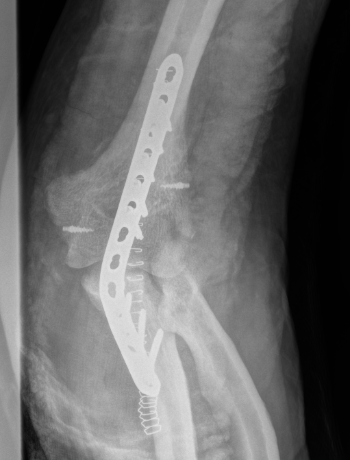 Arthrodesis | The Bone School